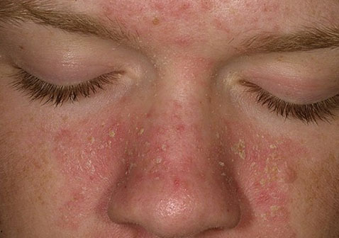 What is Seborrheic Dermatitis